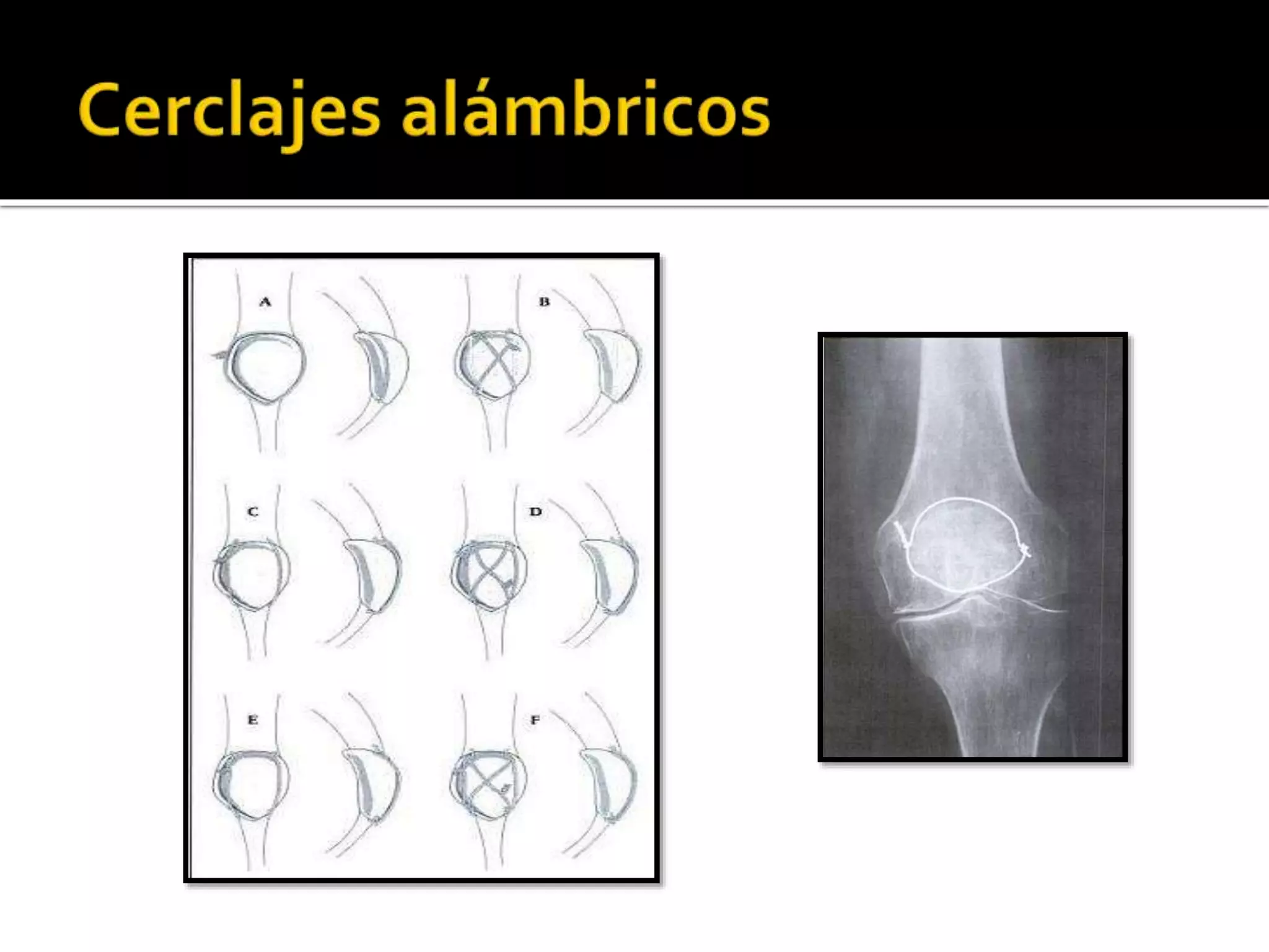 Fractura de rótula | PPTX