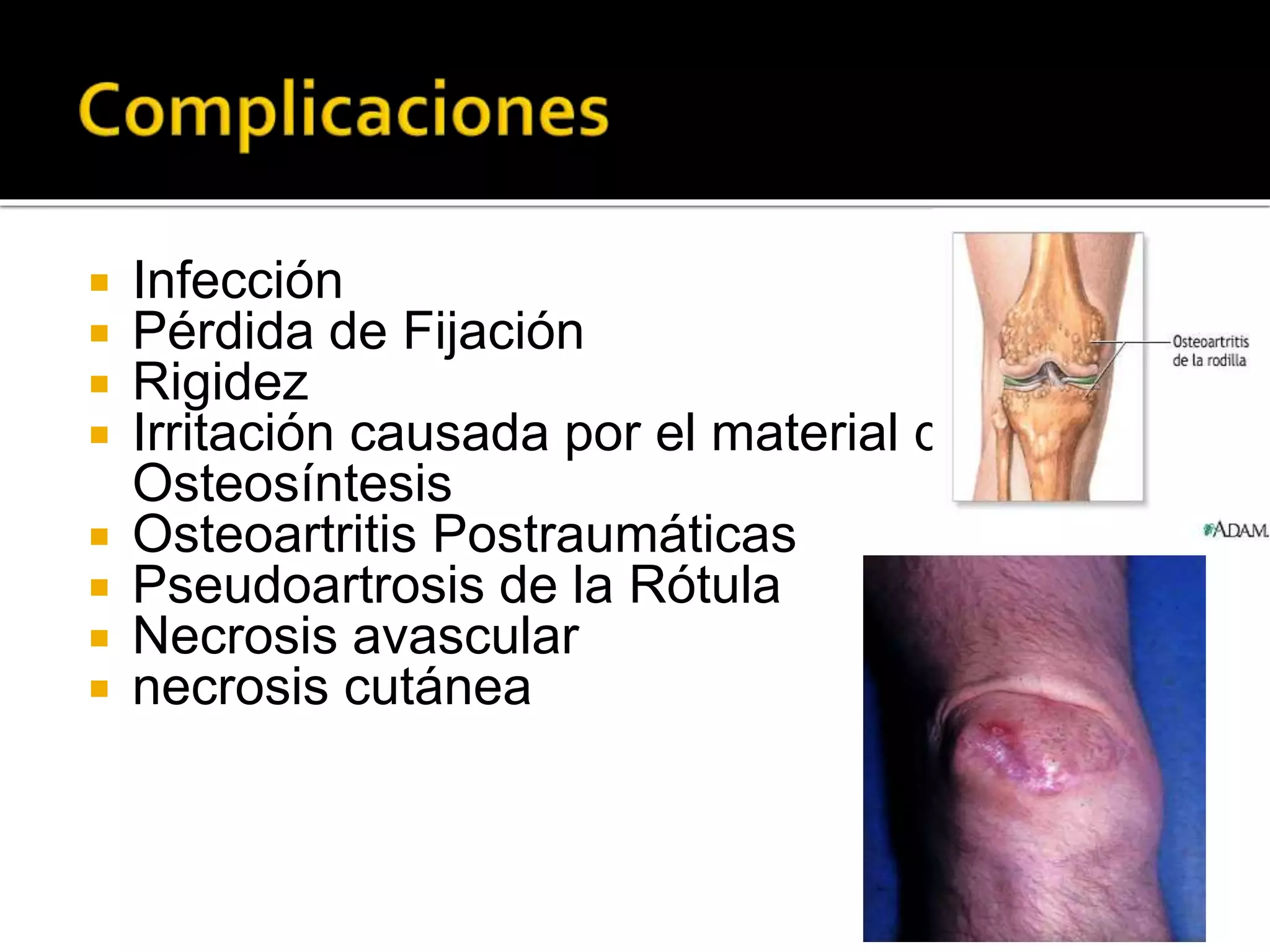 Fractura de rótula | PPTX