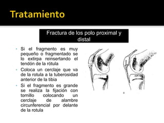Fractura de rótula | PPTX