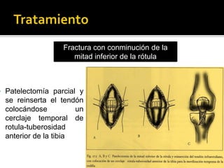 Fractura de rótula | PPTX