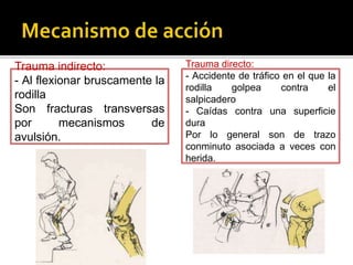 Fractura de rótula | PPTX