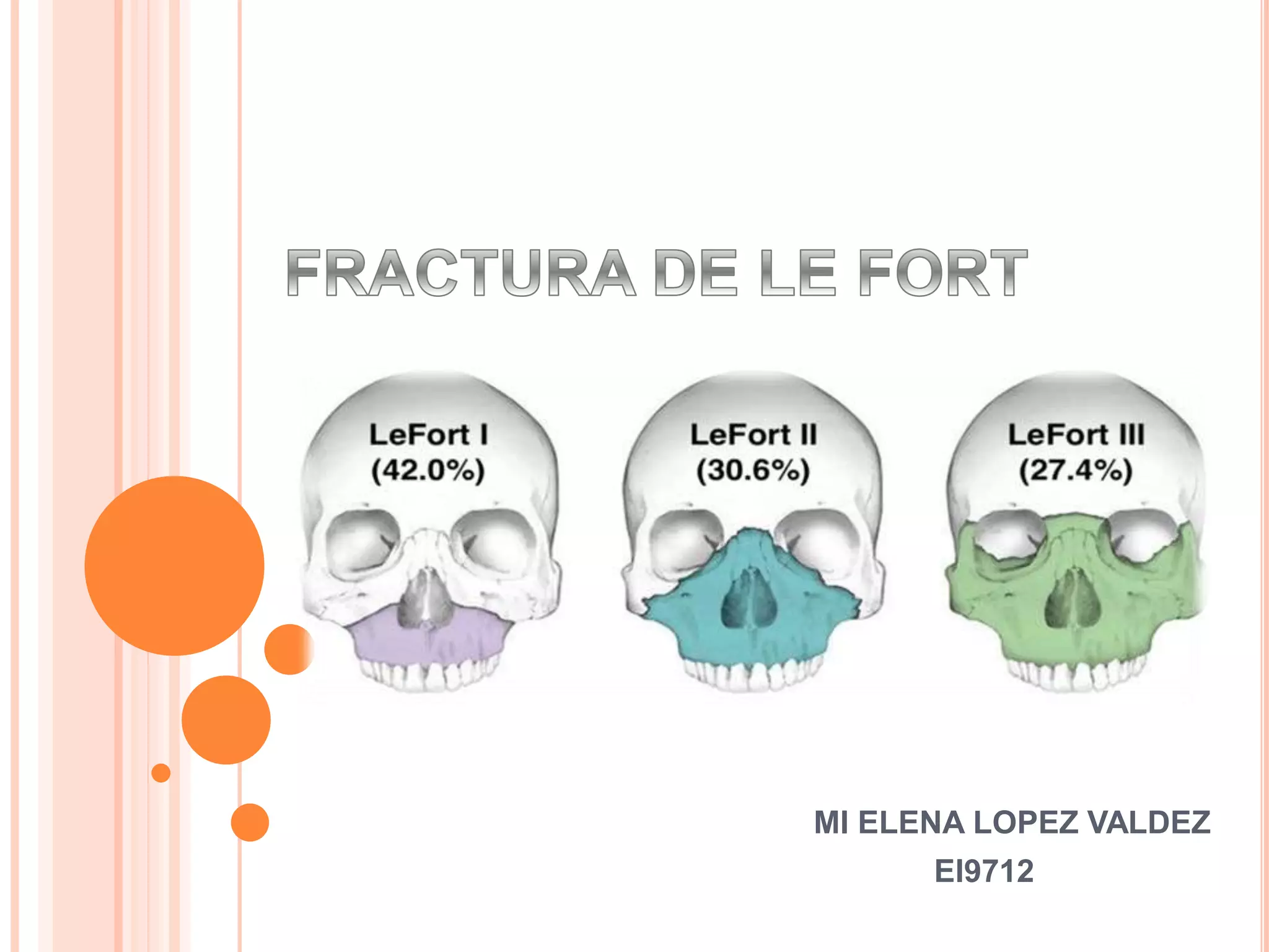 FRACTURA DE LE FORT.pptx