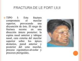 FRACTURA DE LE FORT.pptx