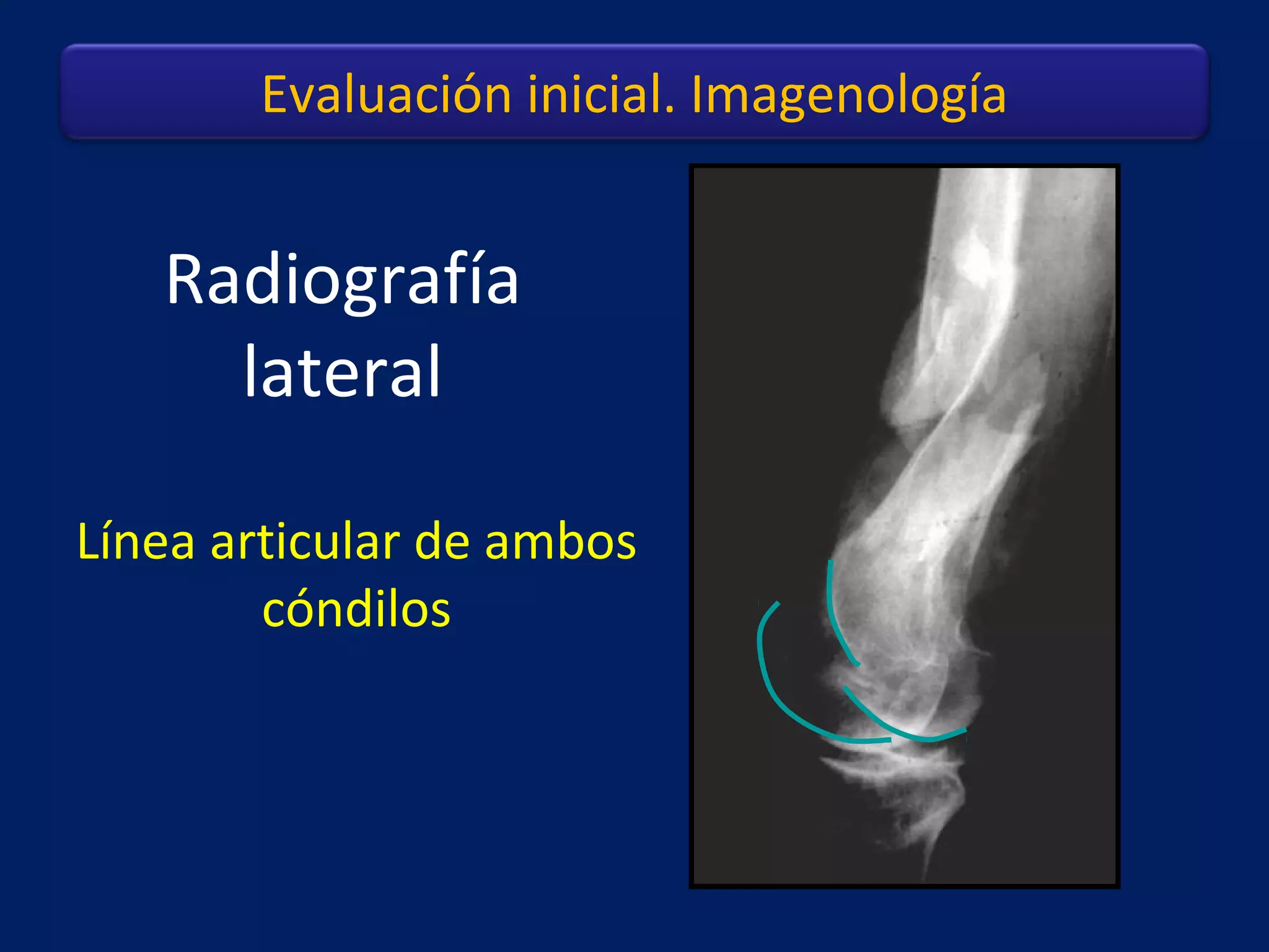 Fractura del extremo distal del femur | PPT