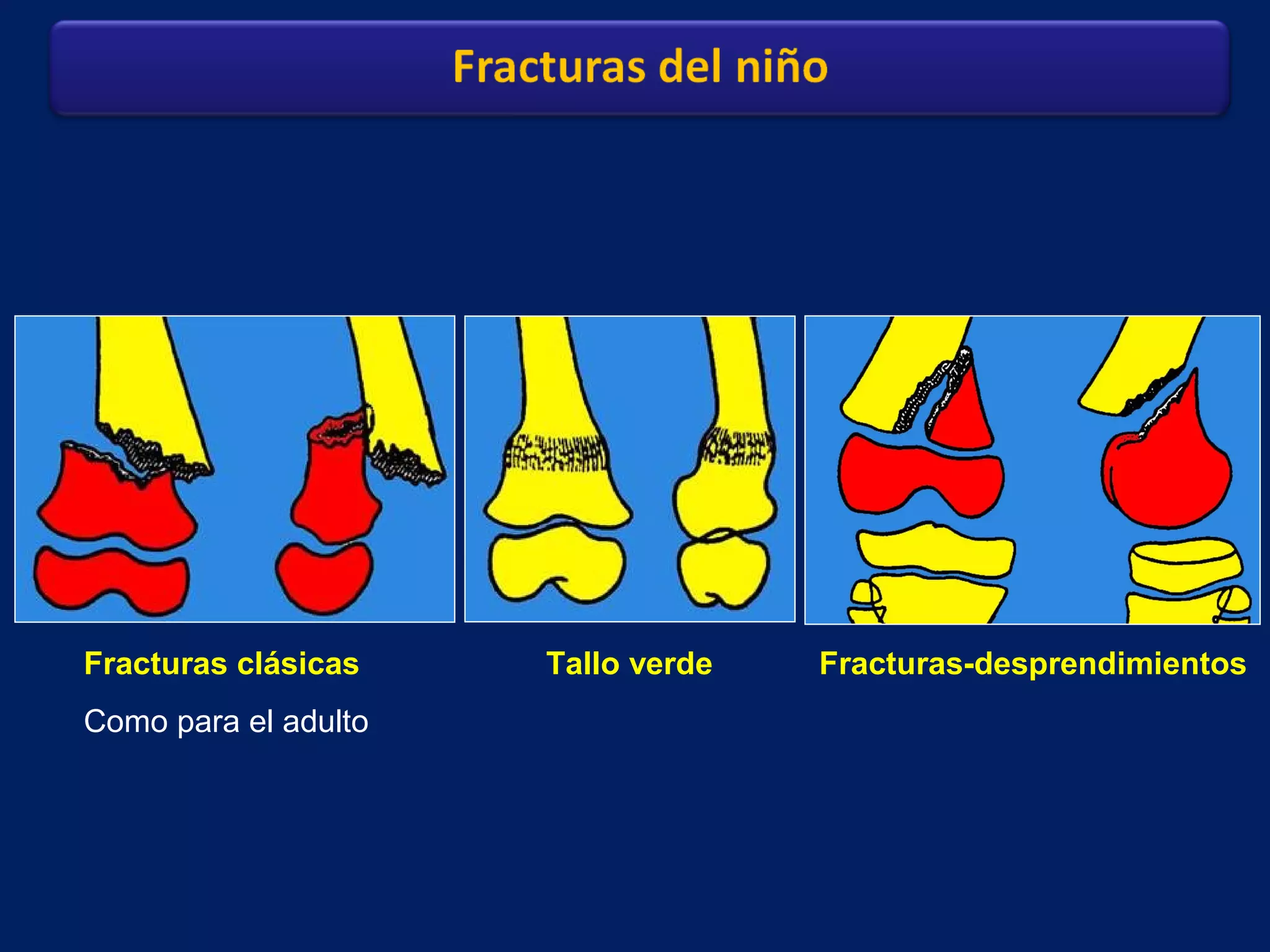 Fractura del extremo distal del femur | PPT
