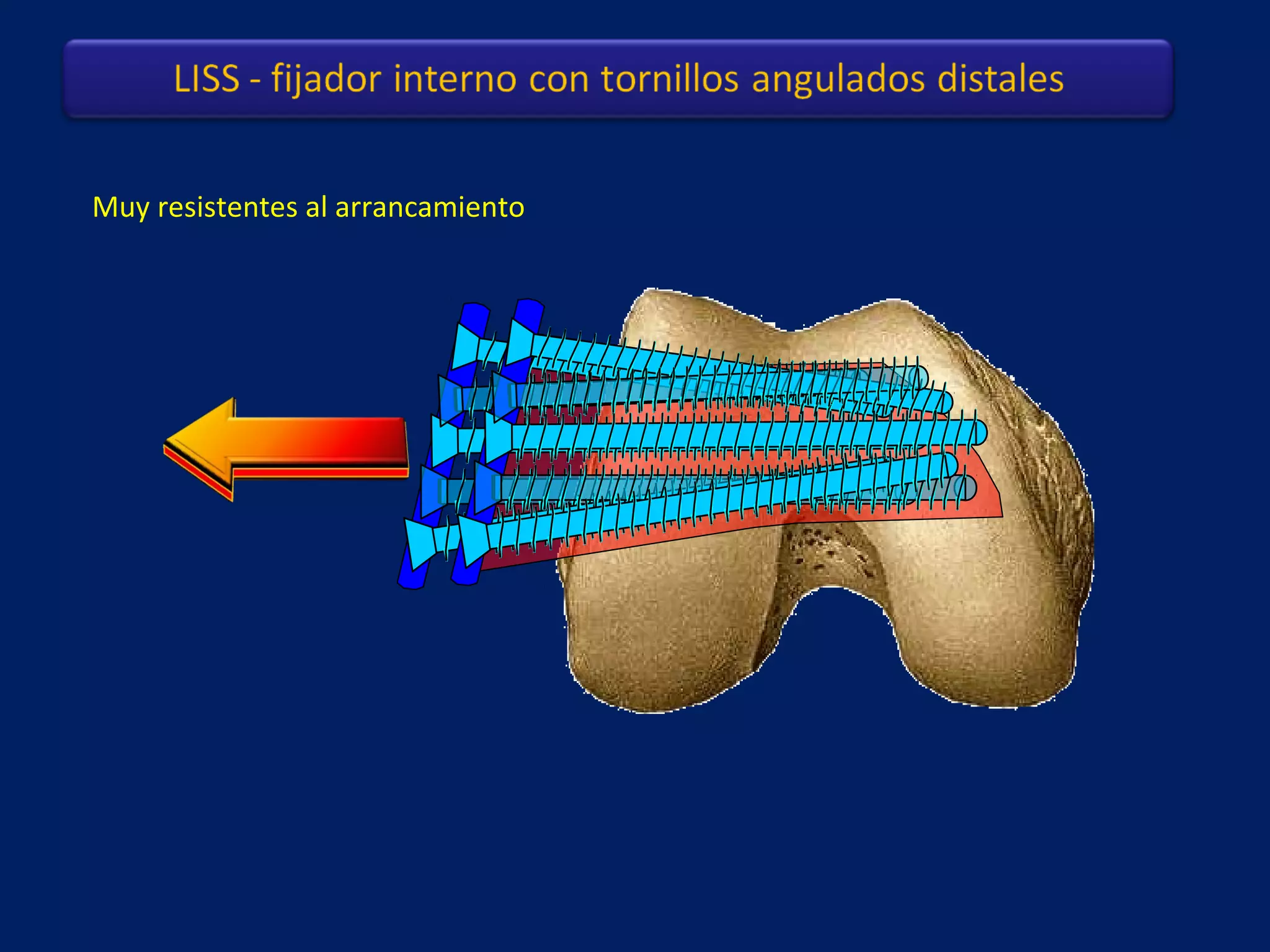 Fractura del extremo distal del femur | PPT