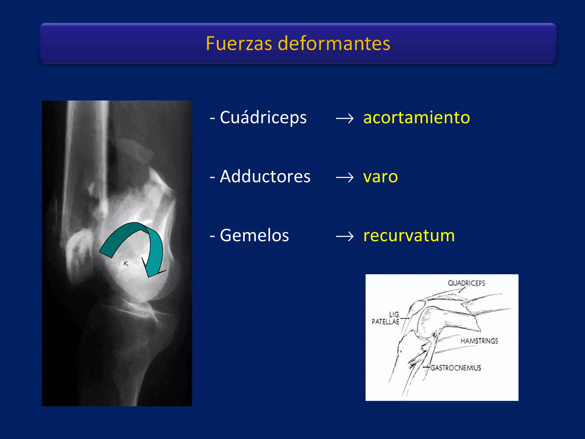 Fractura del extremo distal del femur | PPT