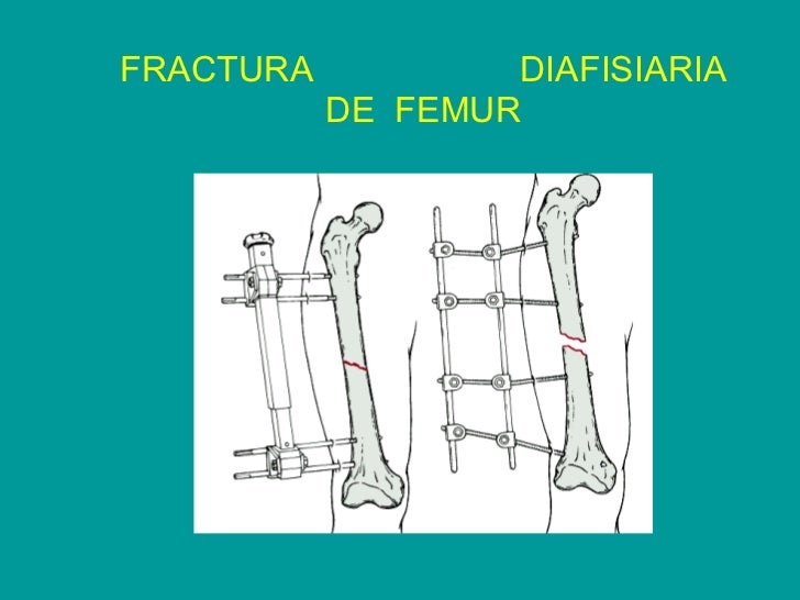 Fractura Del Extremo Distal Y Diafisis Del Femur Walter
