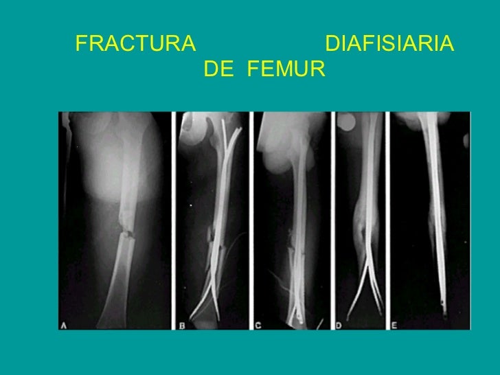 Fractura Del Extremo Distal Y Diafisis Del Femur Walter