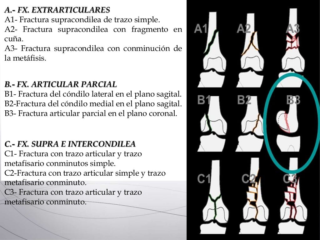Fractura del femur distal