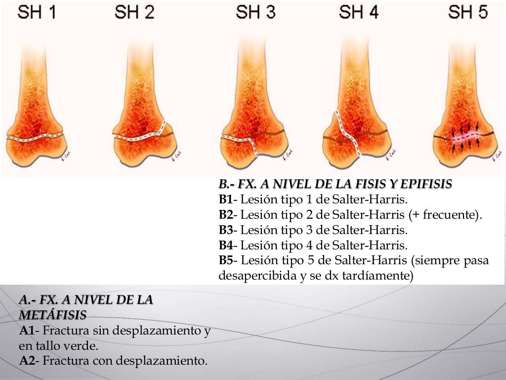 Fractura del femur distal