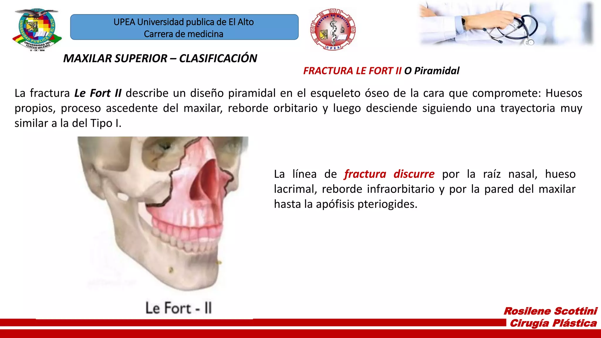 Fractura Maxilar Superior | PDF