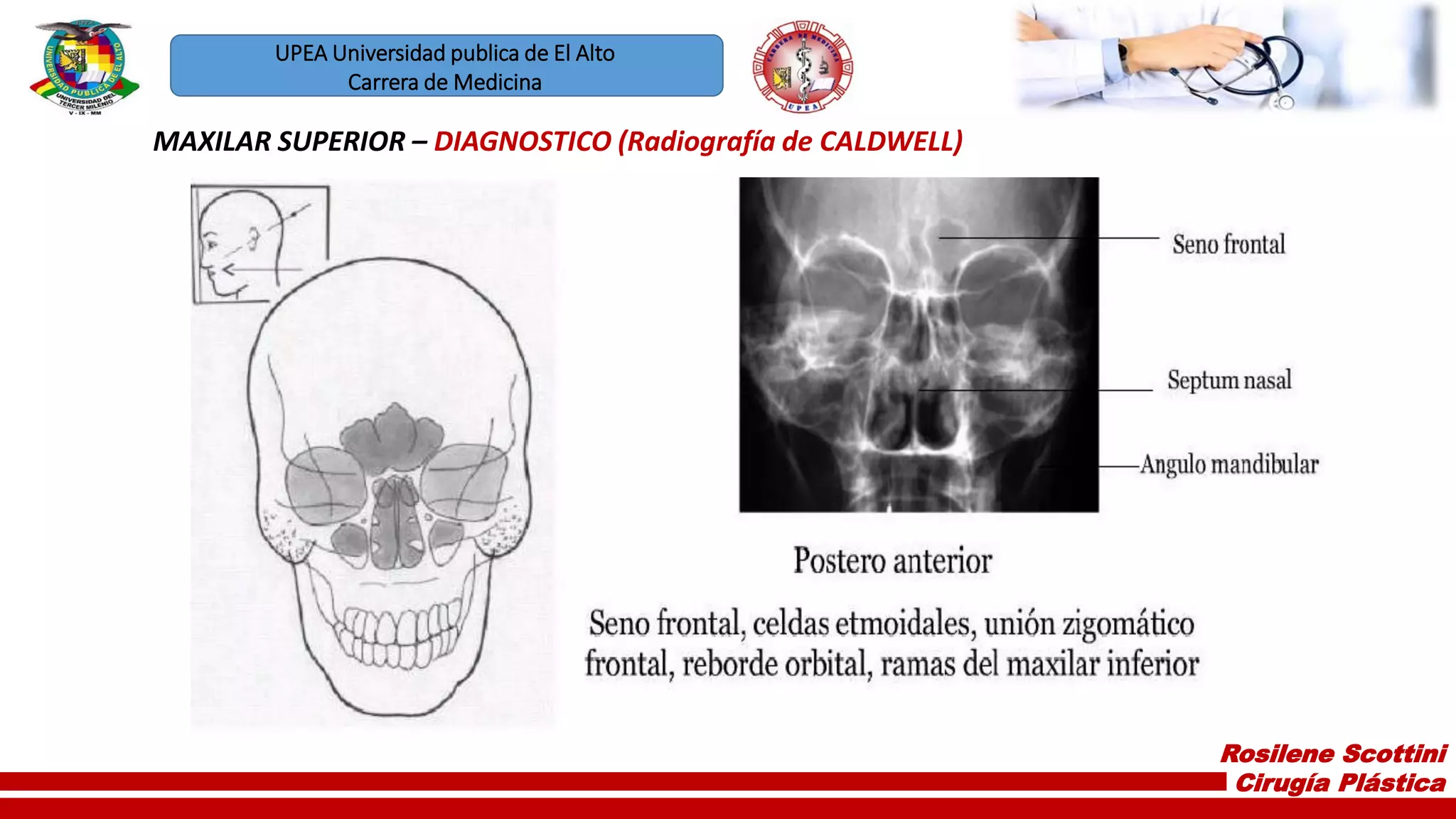 Fractura Maxilar Superior | PDF