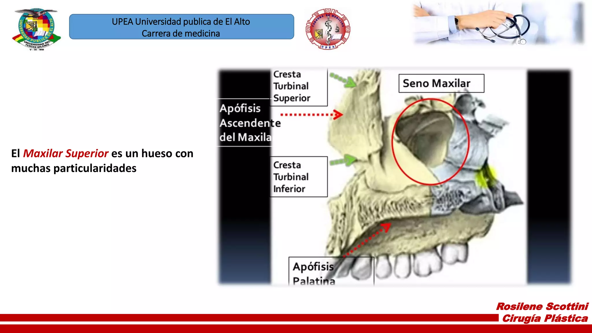 Fractura Maxilar Superior | PDF
