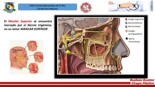 Fractura Maxilar Superior | PDF