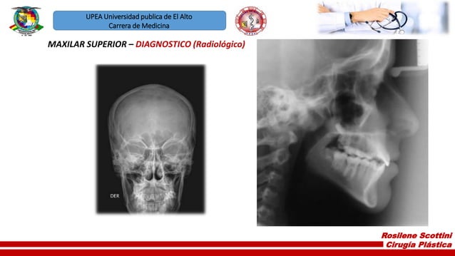 Fractura Maxilar Superior | PDF