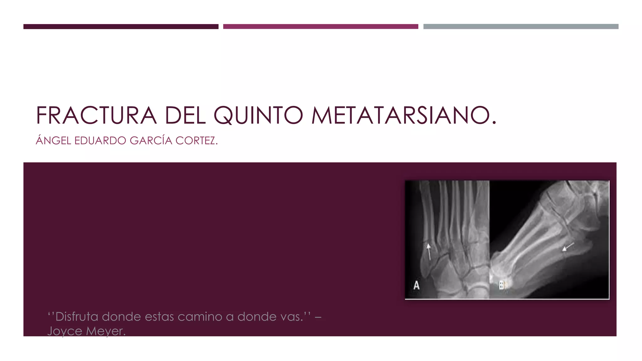 Fractura del quinto metatarsiano | PPTX