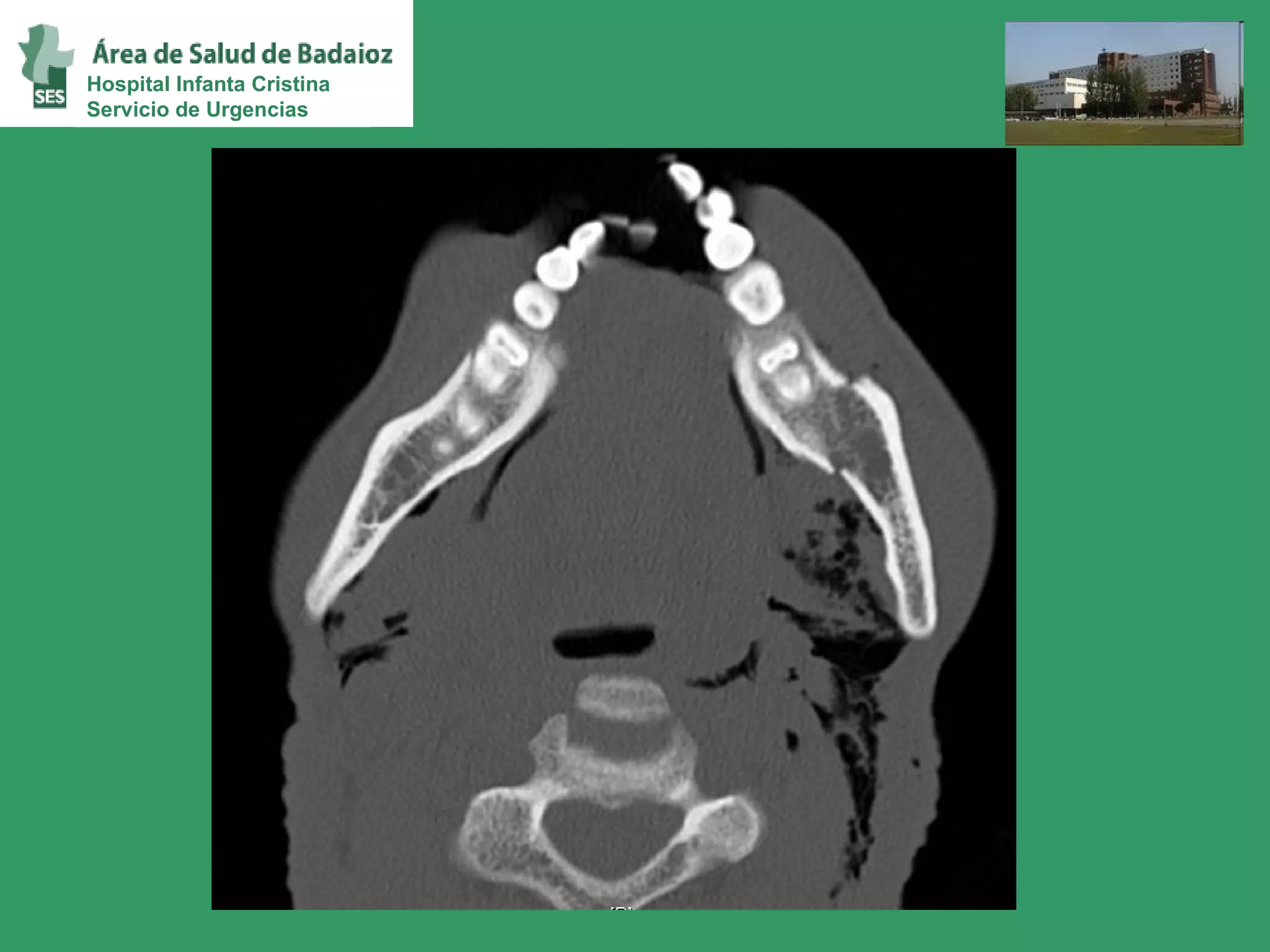 Fractura de mandibula[Dr. Juanjo Arroyo] | PPT