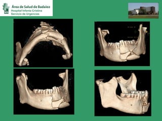 Fractura de mandibula[Dr. Juanjo Arroyo] | PPS