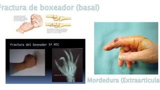 Fractura de mano | PPTX