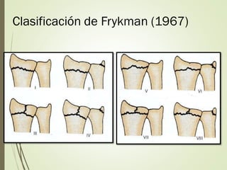 Fracturademueca- modificado | PPTX
