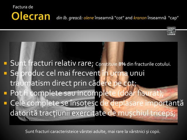 Fractura de olecran | PPTX