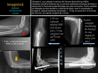 Fractura de olecran | PPTX