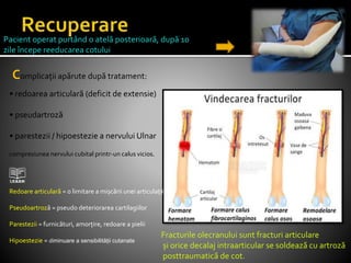 Fractura de olecran | PPTX