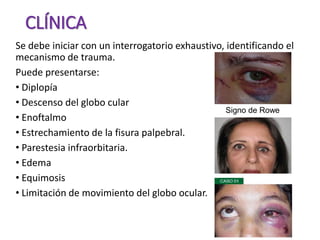 Fractura de orbita | PPT