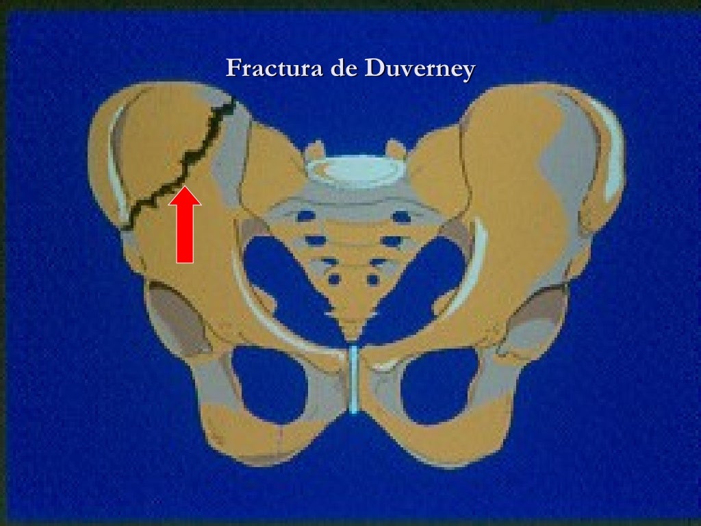 Fractura De Pelvis
