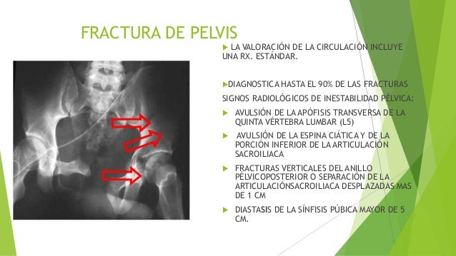Fractura de pelvis
