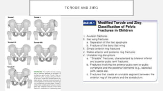 FRACTURA DE PELVIS .pptx