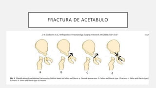 FRACTURA DE PELVIS .pptx