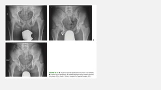 FRACTURA DE PELVIS .pptx