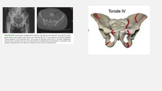 FRACTURA DE PELVIS .pptx