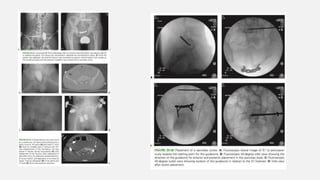 FRACTURA DE PELVIS .pptx