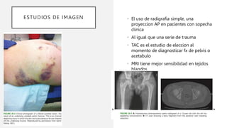 FRACTURA DE PELVIS .pptx