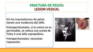 FRACTURA DE PELVIS - DIAPOSITIVAS DE TRAUMATOLOGIA | PDF