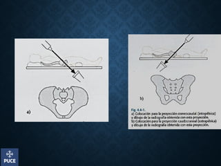 FRACTURA DE PELVIS TRAUMATOLOGIA Y ORTOPEDIA .pptx