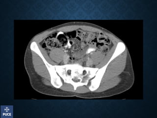 FRACTURA DE PELVIS TRAUMATOLOGIA Y ORTOPEDIA .pptx