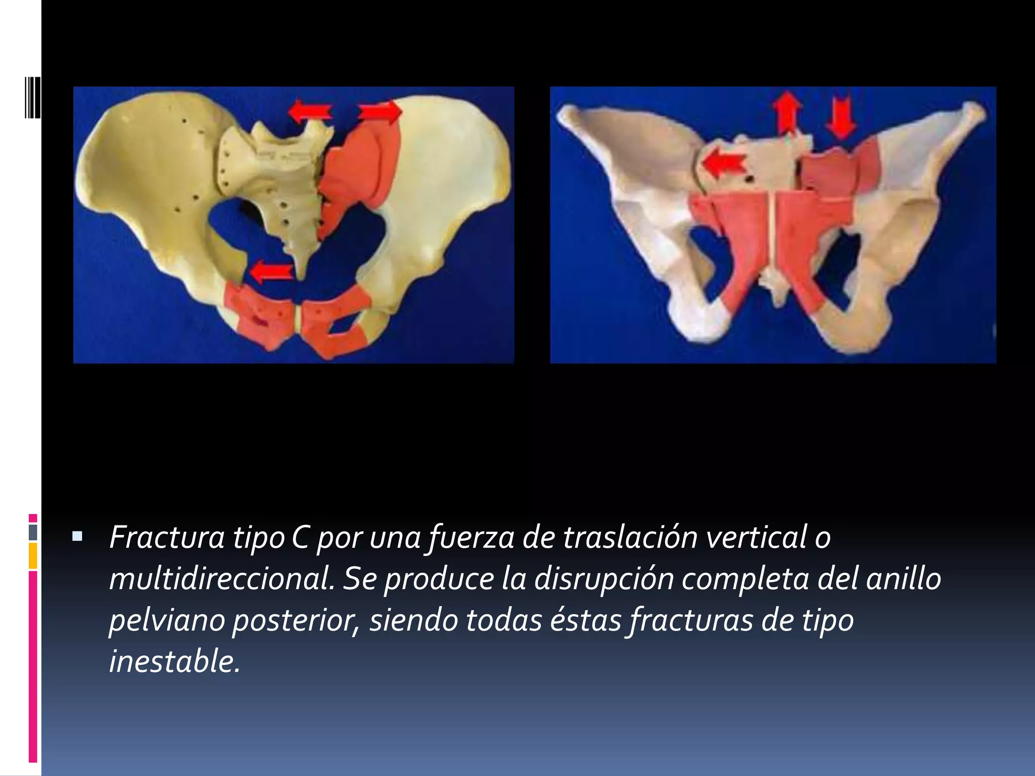 Fractura de pelvis trauma1total | PPTX