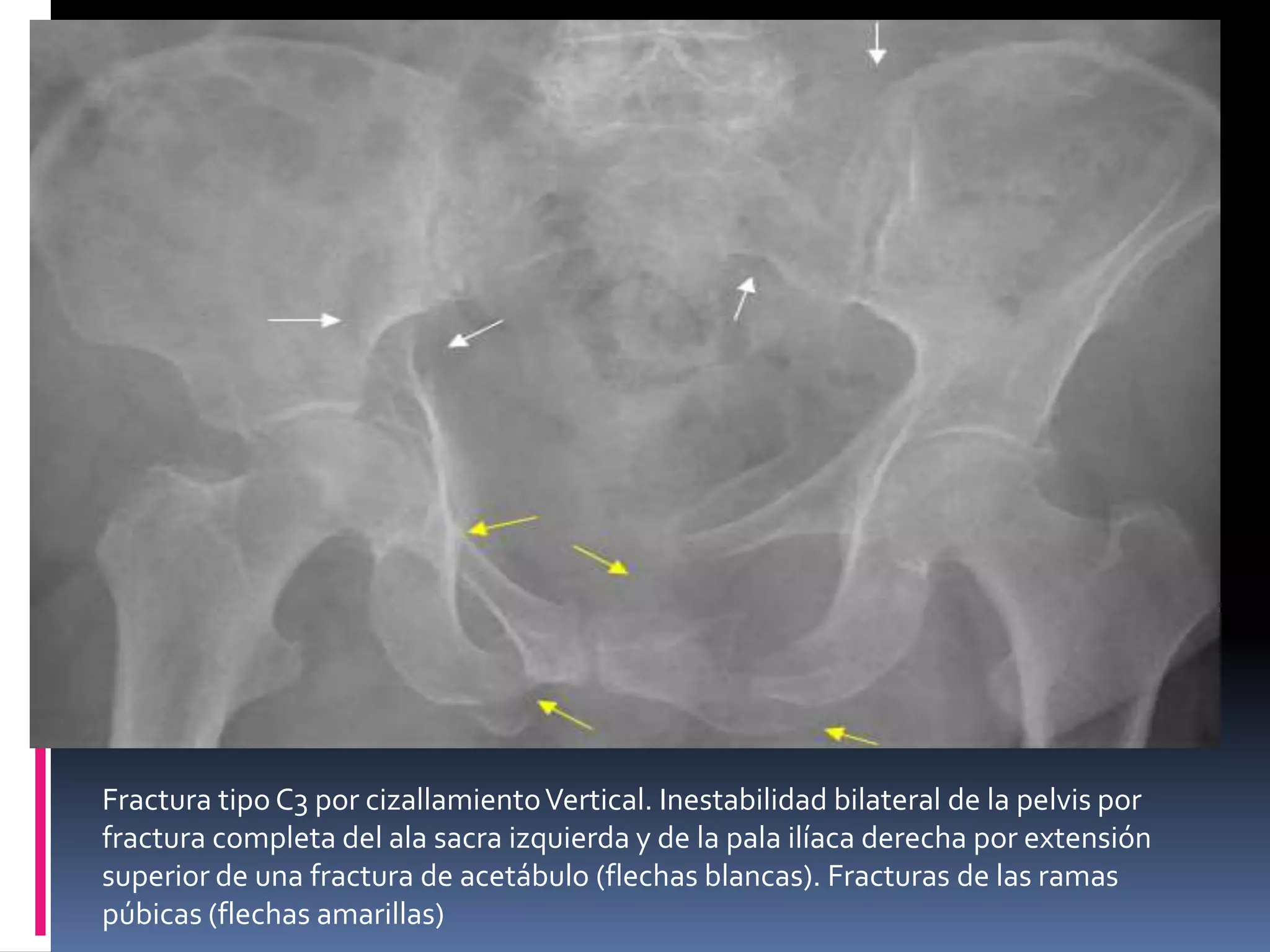 Fractura de pelvis trauma1total | PPTX