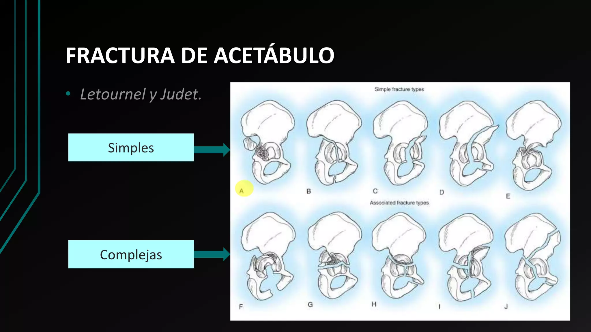 Fractura de pelvis y acetabulo | PPTX