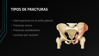 Fractura de pelvis y acetabulo | PPTX