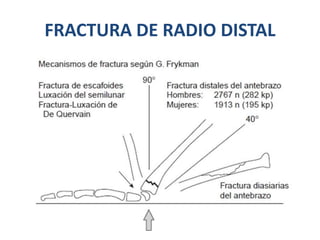 Fractura de radio distal | PPTX