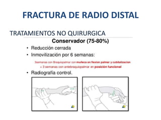 Fractura de radio distal | PPTX