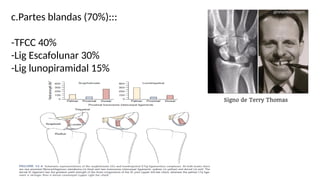 FRACTURA DE RADIO DISTAL AO- TRAUMATOLOGIA Y ORTOPEDIA.pptx