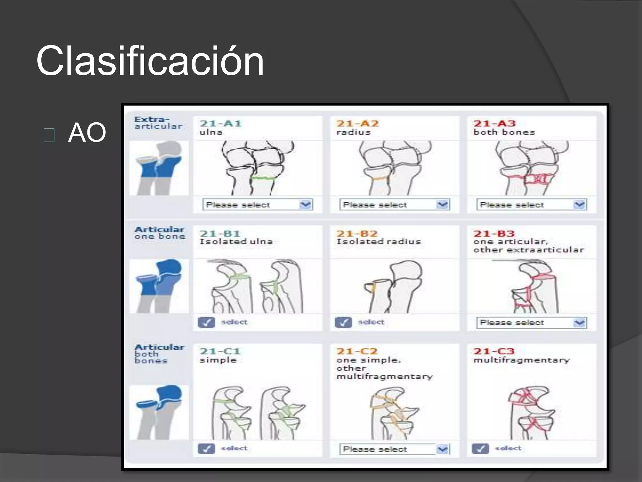 Fractura de radio y cubito proximal | PPTX