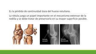 Fractura de rotula | PPTX