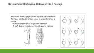 Fractura de rotula | PPTX